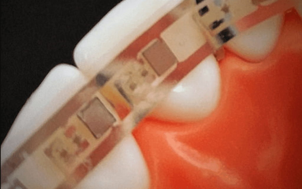 3D Printed Braces with LED Lights and Micro Batteries Save Time and ...