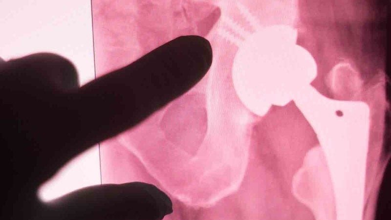 3D Printed Ceramic Implant Fuses With Bone to Repair Broken Limbs | All3DP