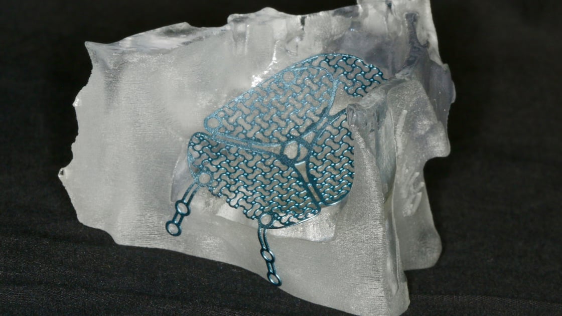 Boosting Surgical Outcomes with 3D Printing at University Hospital ...