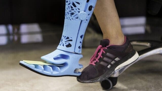 3d printed prosthetics examples