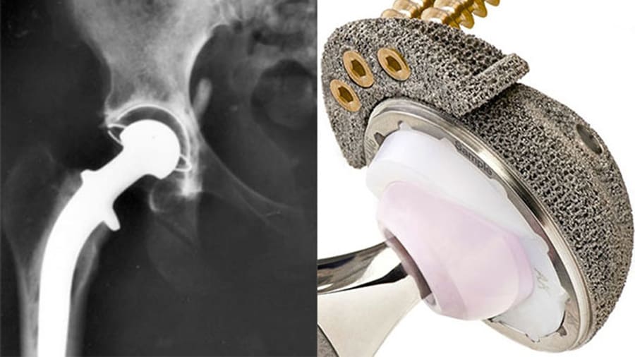 3d printed bones for surgery