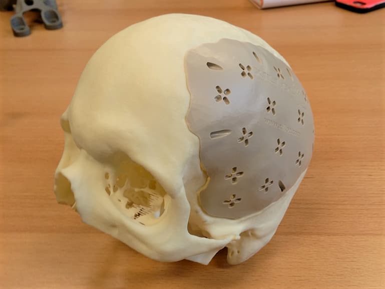 3d printed bones ossiform when released