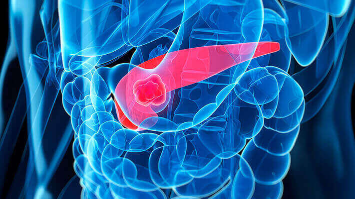 Bioprinting an Artificial Pancreas for Type 1 Diabetes | All3DP