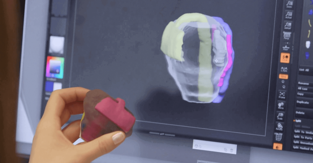 3D Printing Prostate Cancer Models for Surgical Planning | All3DP