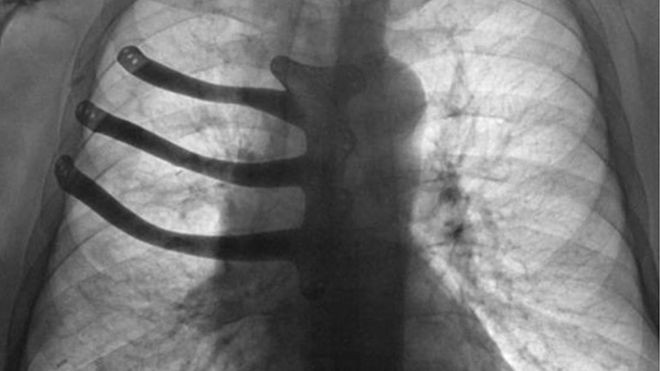 Surgeons use 3D Printed Titanium Implant to Rebuilt Man's Breastbone ... Surgeons use 3D Printed Titanium Implant to Rebuilt Man's Breastbone ...